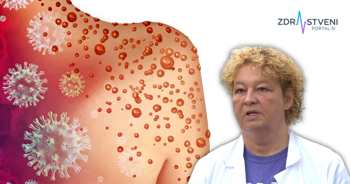 Opičje koze (mpox) – kakšni so simptomi in kako se razlikujejo od ...